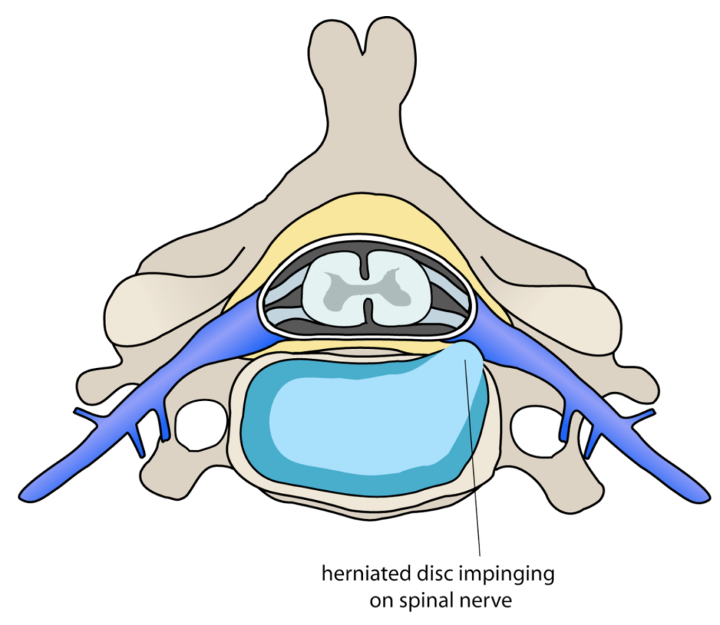 Herniated Disc - Sarasota Spine Specialists