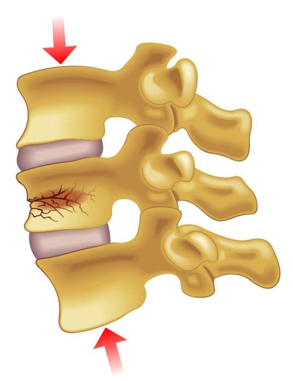 Spinal Fracture - Sarasota Spine Specialists