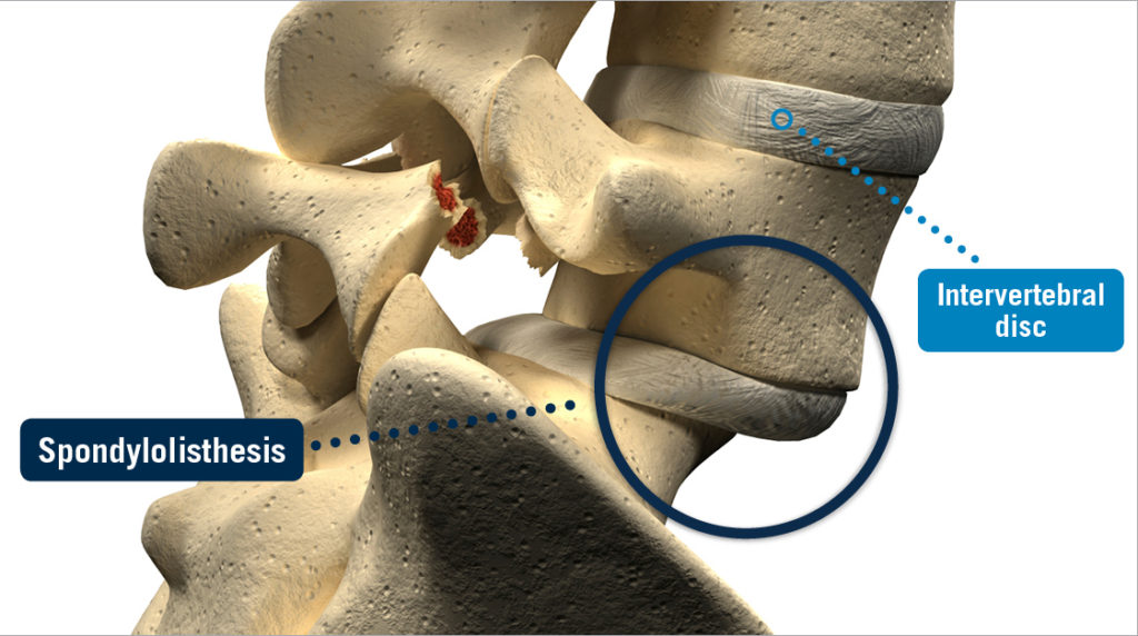 Spondylolisthesis - Sarasota Spine Specialists